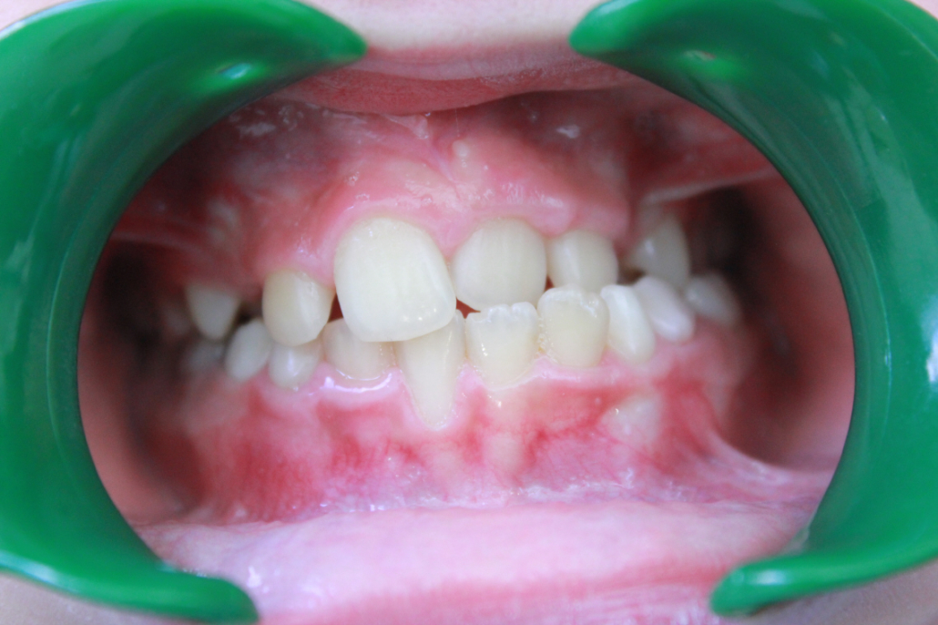 orthodontie chez l'enfant Marseille la Valentine 11ème Docteur Luc ...